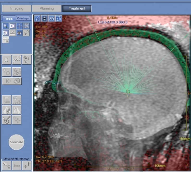Ohio State Leading World’s First Study Using Focused Ultrasound to ...